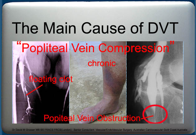 Popliteal vein compression syndrome the MAIN cause of DVT, unrecognise