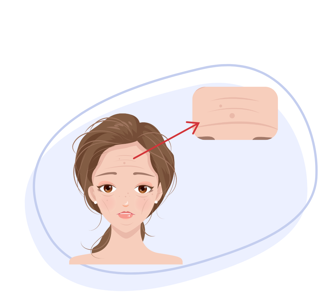 Horizontal Forehead Lines | Epicare Health