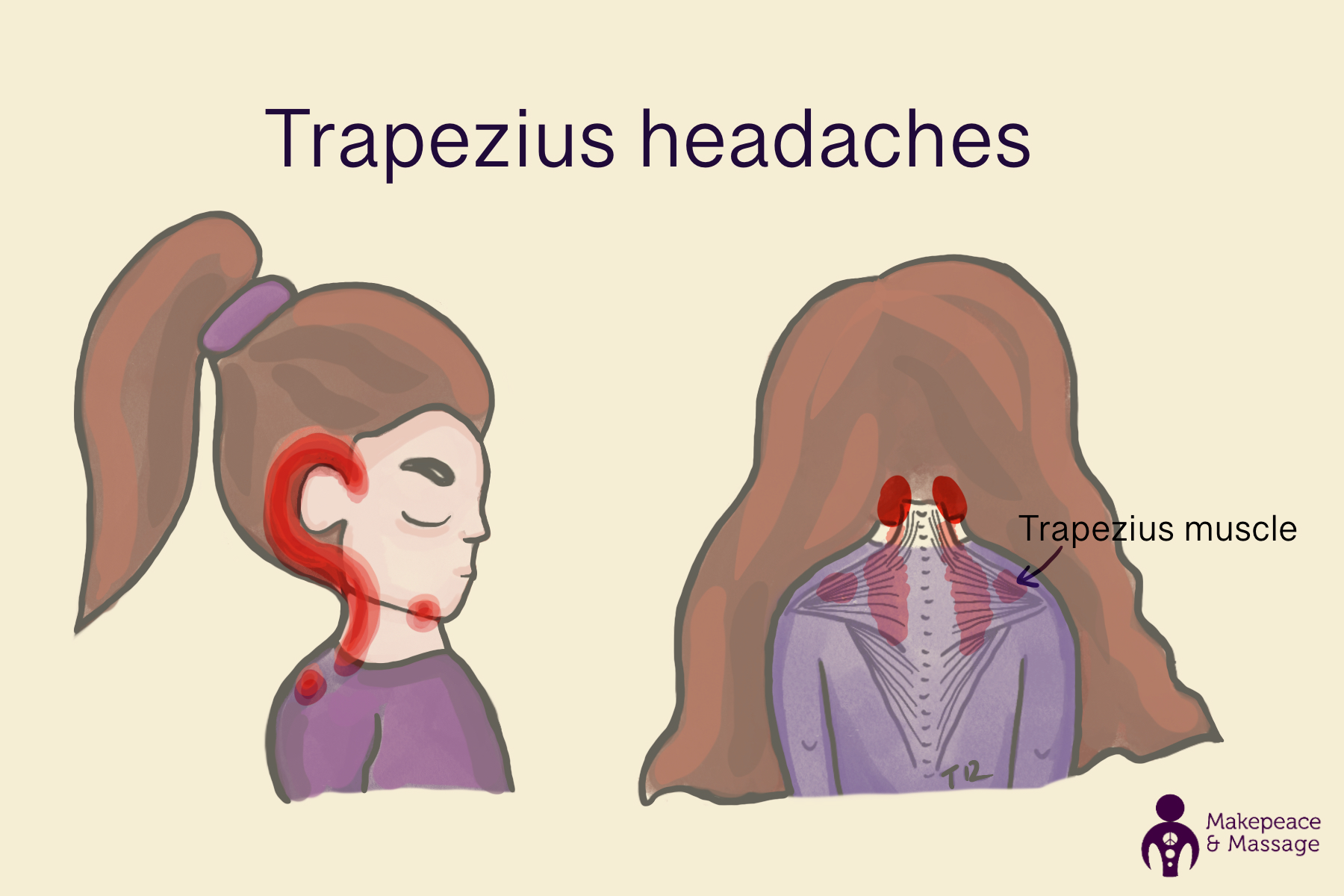 Trapezius headache | Makepeace & Massage