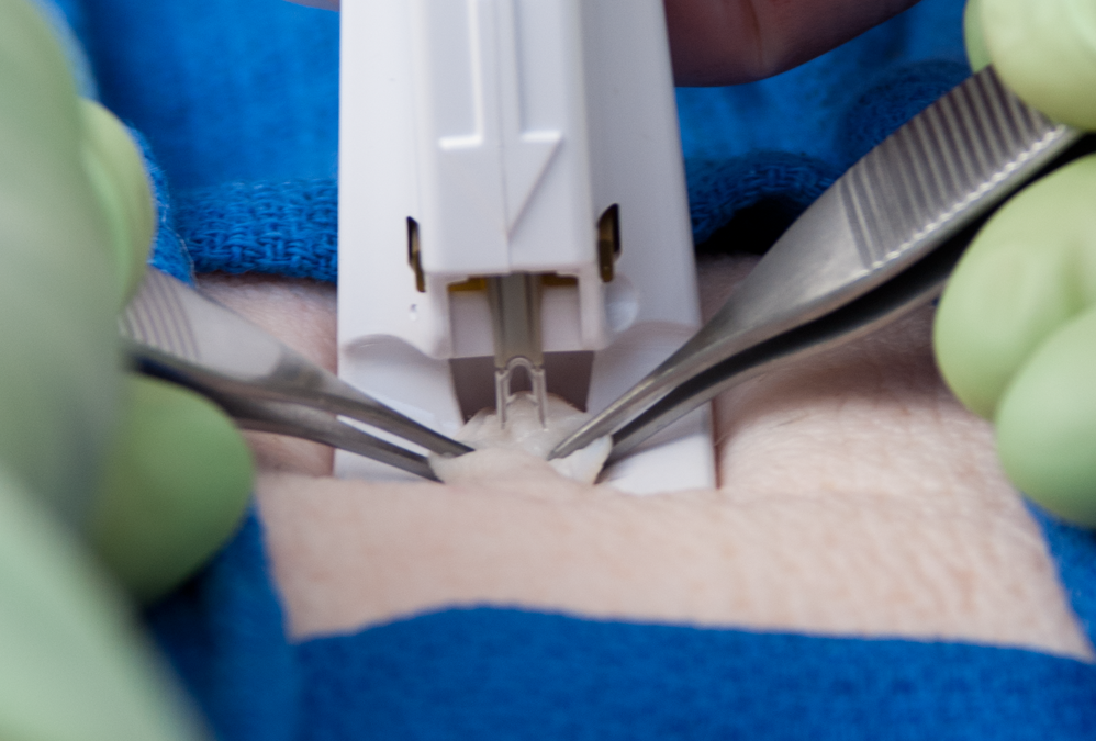 Photos of the SubQ It! Bioabsorbable Skin Stapler