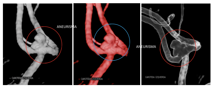 Embolización de aneurisma con utilización de Stent en Y, y Coils