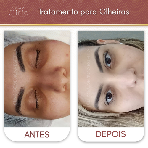Tratamento De Olheiras Clinic Bio