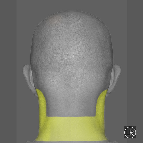 Nape of Neck Six | Laserremedy