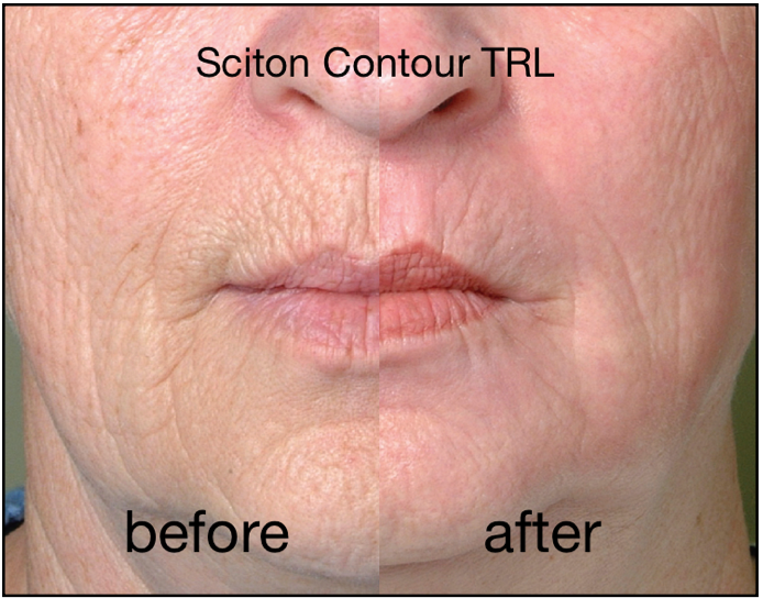 Get Rid of those Barcode Lips