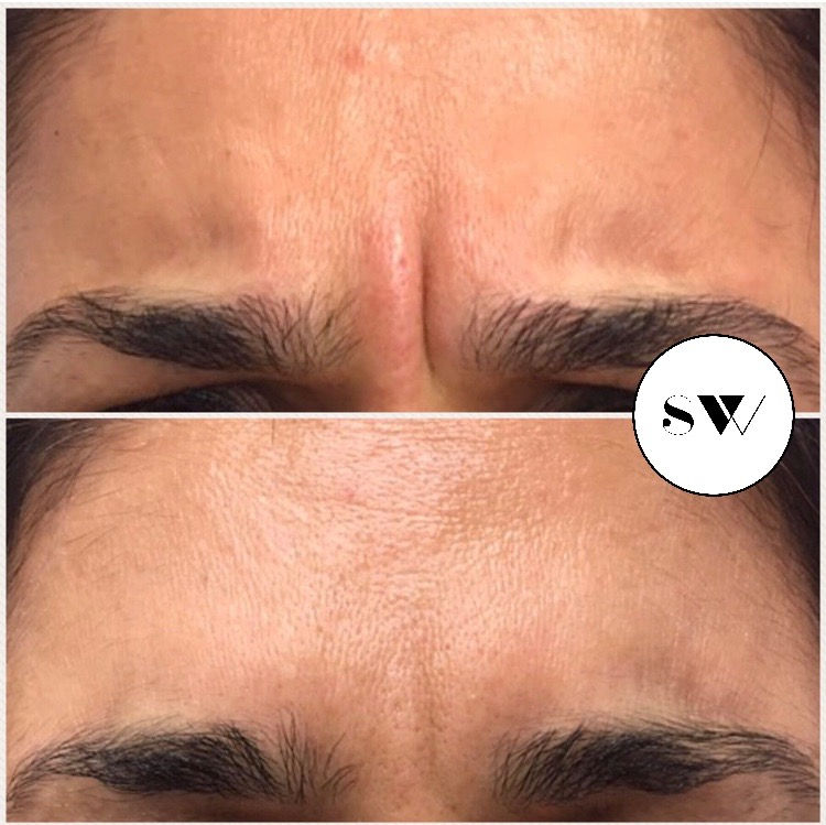 What is the Perfect Age to Start Botox?