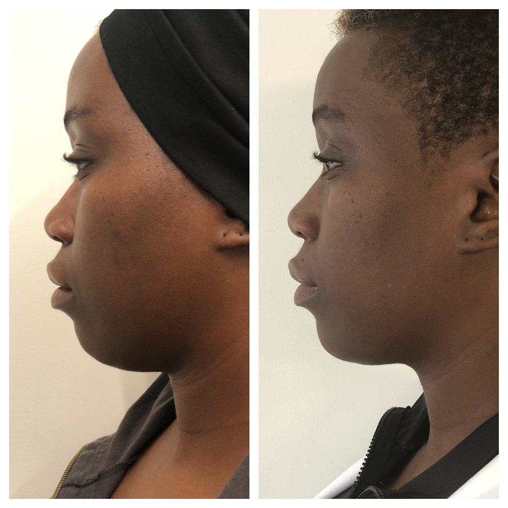 Cocktail Therapy: The Beauty Secret to Facial Rejuvenation