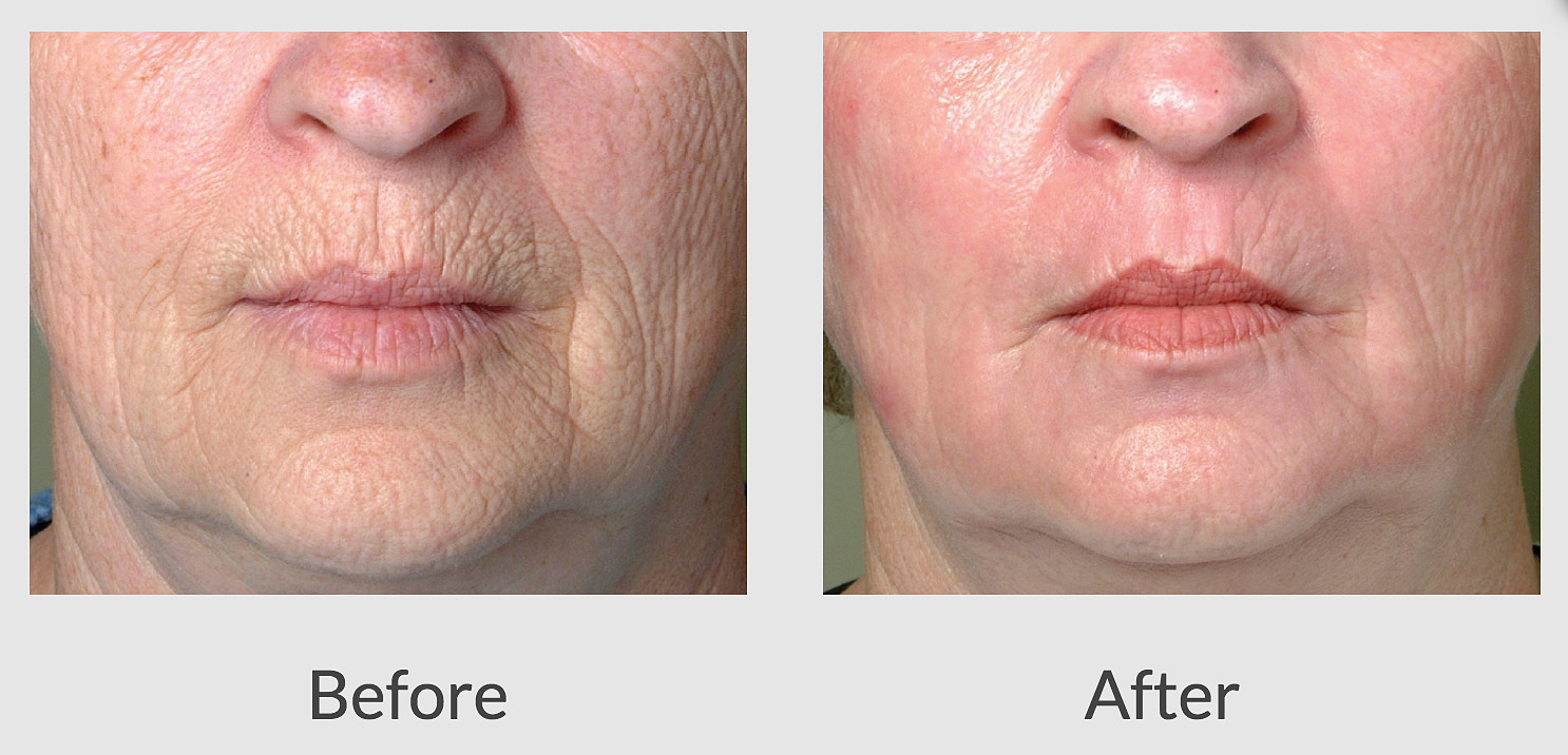 skinworthy | DEEP SKIN RESURFACING