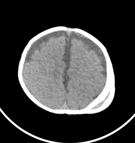 Caso: Cefalohematoma calcificado