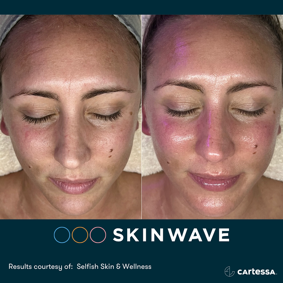 Skinwave Facial | Skin Lab