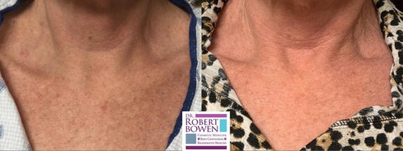 BBL | Dr. Robert Bowen | Martinsburg, WV