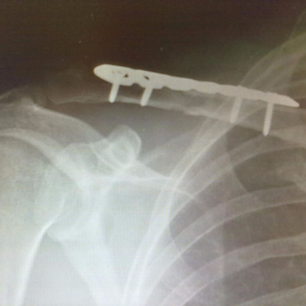 What is the best treatment for a broken (fractured) and/or dislocated ...