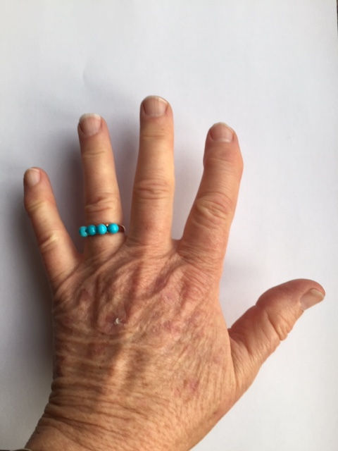 Copper deficiency, other minerals and rheumatoid arthritis