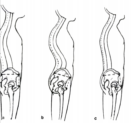 3 Easy Steps to Relieve Low Back Pain