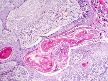 Cutaneous squamous cell carcinoma