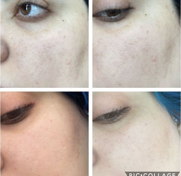 Before & After Gallery | Peachy Skin Care