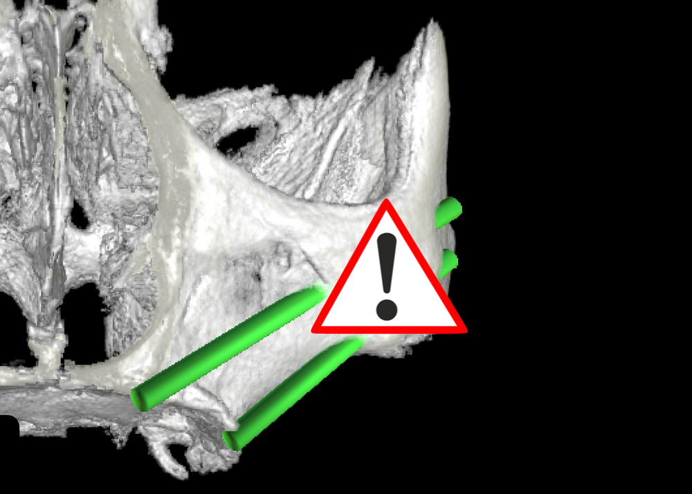 Zygoma Fracture During Zygomatic Implant Installation