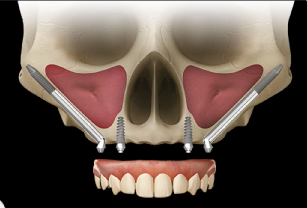 Curso ZIGOMA 2.0 - A nova era dos Implantes Zigomáticos