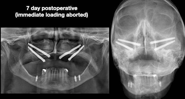 Zygoma Fracture During Zygomatic Implant Installation