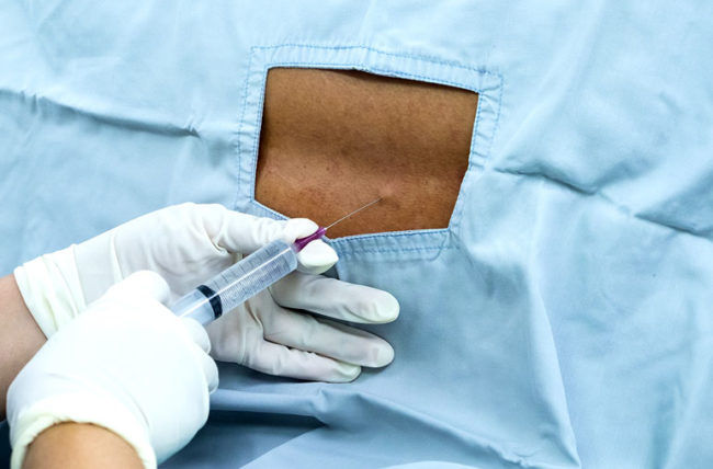 Peripheral Nerve Blocks and Stimulators