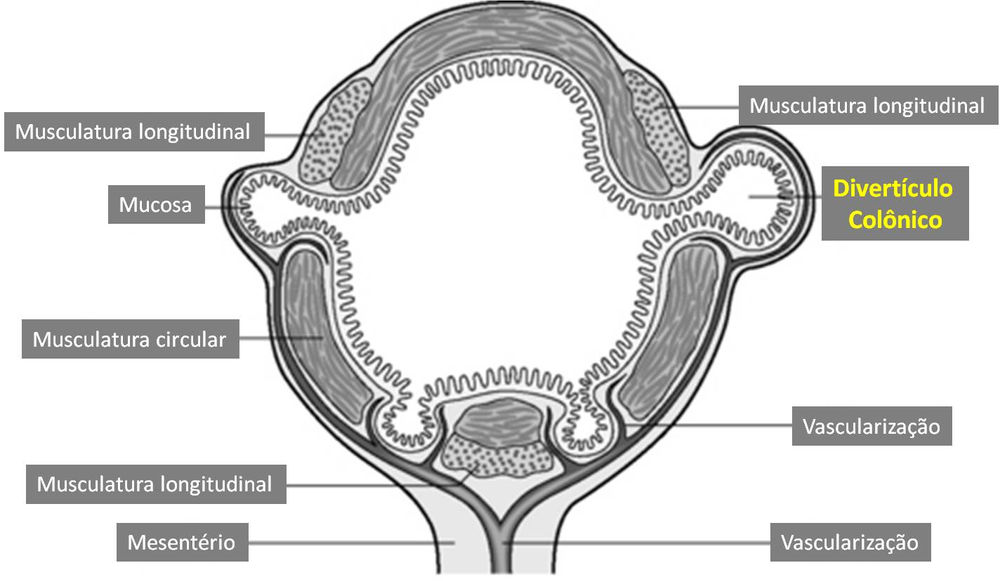 DIVERTICULOSE, DOENÇA DIVERTICULAR E DIVERTICULITE – QUAIS AS DIFERENÇAS?