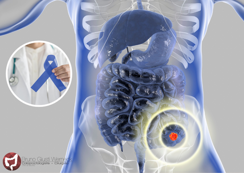 Câncer de intestino é um problema de todos!