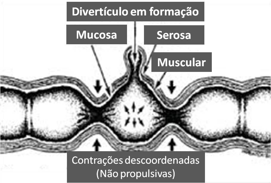 DIVERTICULOSE, DOENÇA DIVERTICULAR E DIVERTICULITE – QUAIS AS DIFERENÇAS?