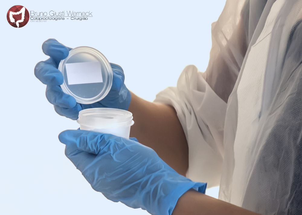 Para que serve o exame de PSOF na prevenção do câncer de intestino?