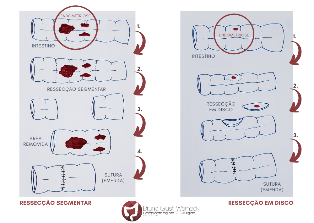 Endometriose no intestino deve ser avaliada por um coloproctologista