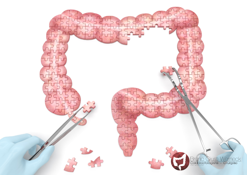 Cirurgia de intestino: como acelerar a recuperação?
