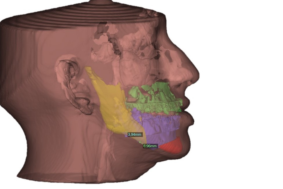 Prognatismo Mandibular