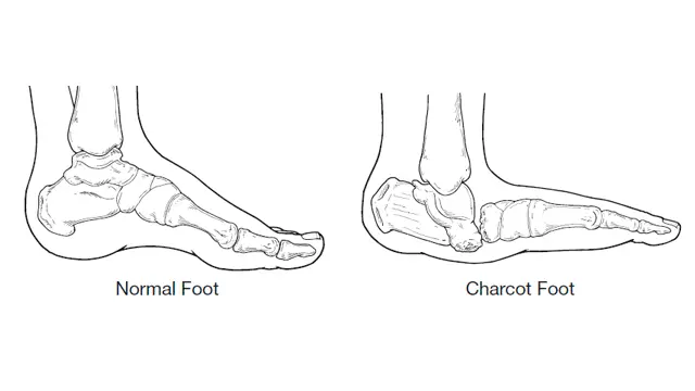 What is Charcot foot? Dr. R. Scott Johnston, Heel and Toe podiatry ...