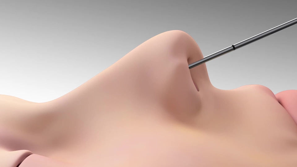 nasal valve stabilization