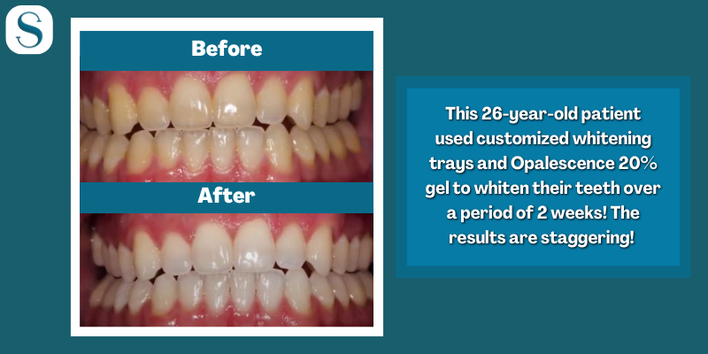 "Is Custom Opalescence Teeth Whitening Worth It Compared to Over-the ...