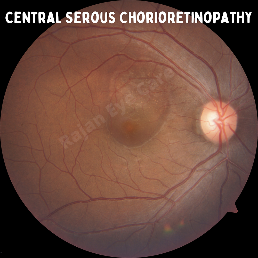 Central Serous Chorioretinopathy Central Serous Chorioretinopathy
