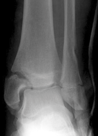 Distal Tibia physeal | fractureland