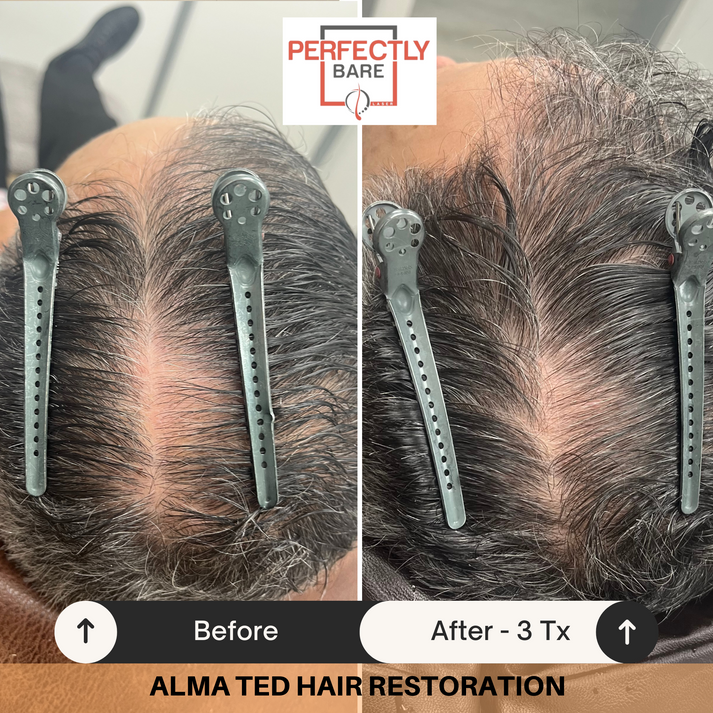 Perfectly Bare Laser | TED Hair Restoration | Tampa FL