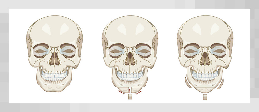 Facial Bone Contouring: Complications and How to Manage