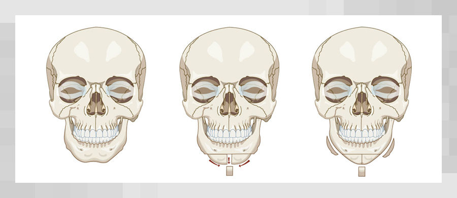 Facial Bone Contouring: Complications and How to Manage