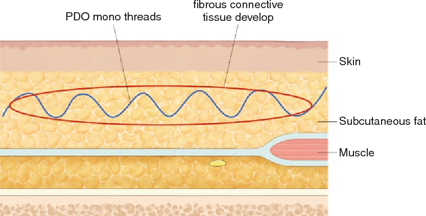 Thread Lift: Techniques and Effects of PDO Mono-Threads