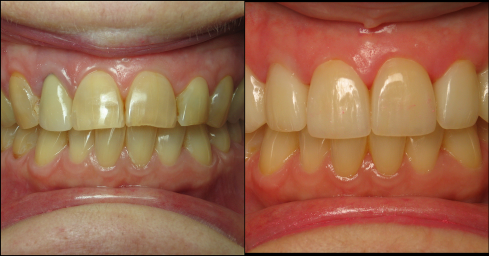 BEFORE & AFTER | Best Implant Dentist Novato CA, David W Epstein DDS