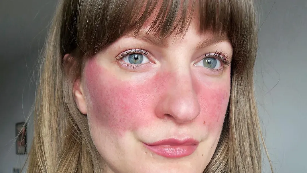 IPL for Stubborn Rosacea: Restore Confidence in Your Skin?