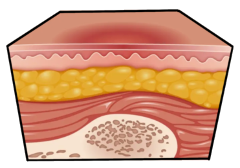 6 Stages of Pressure Ulcers