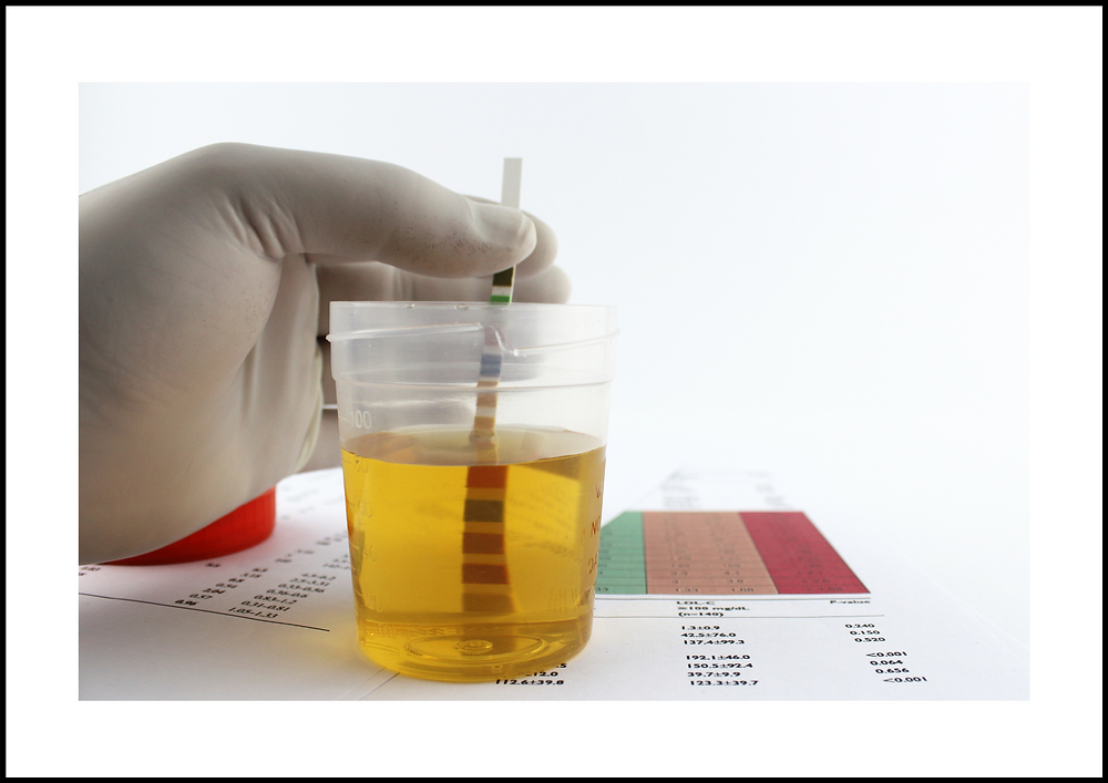 Abnormal Colors of Urine: Causes and Nursing Interventions