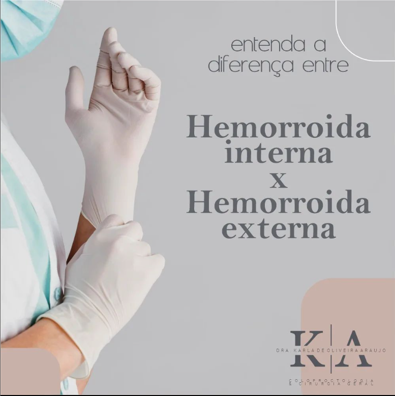 Hemorroida Interna x Hemorroida Externa