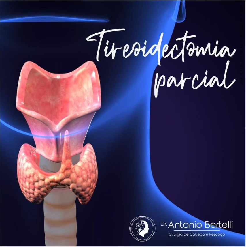 Tireoidectomia parcial