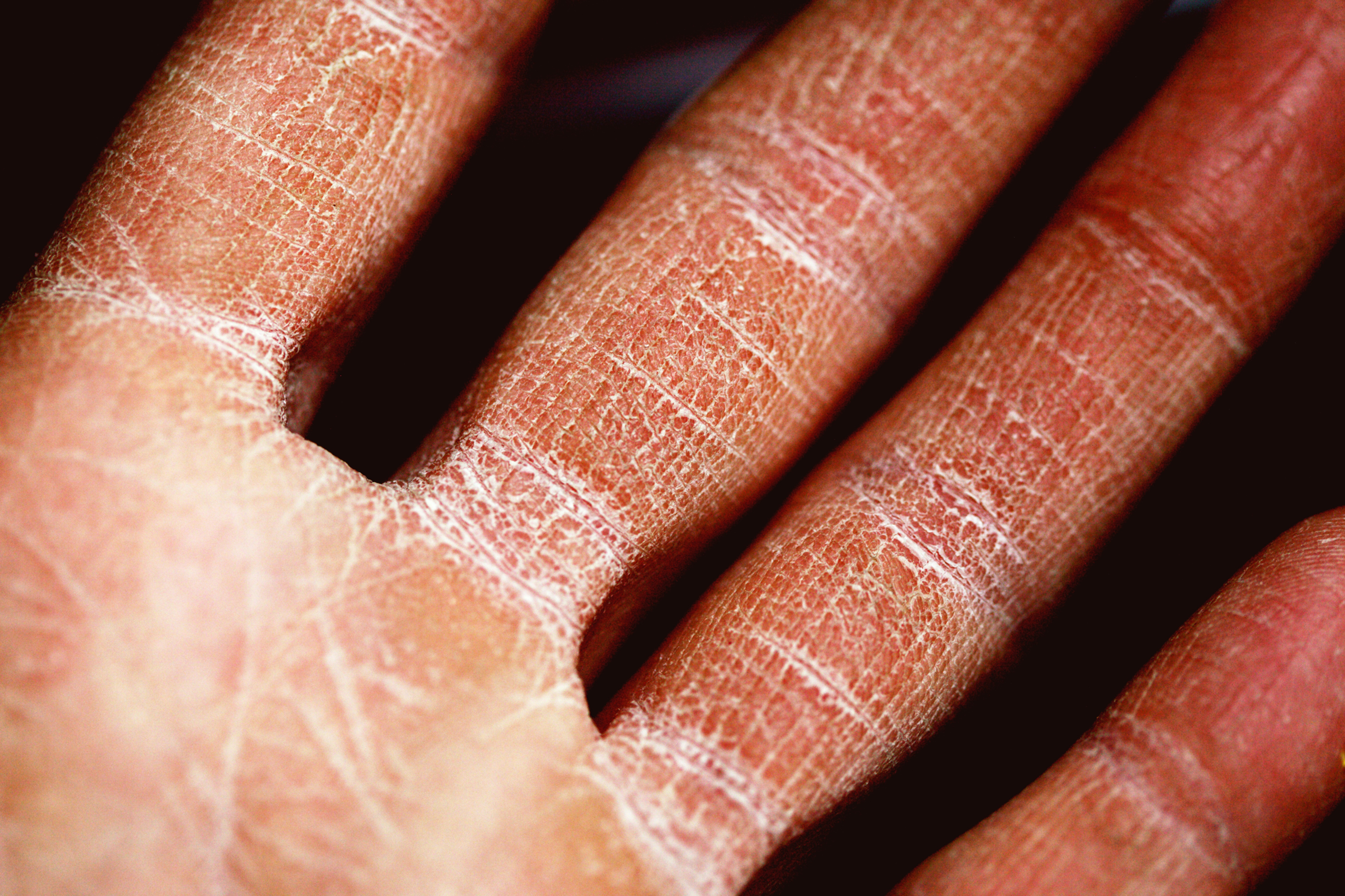 Chemical Peels for the Prevention and Treatment of NMSC: An Overview ...